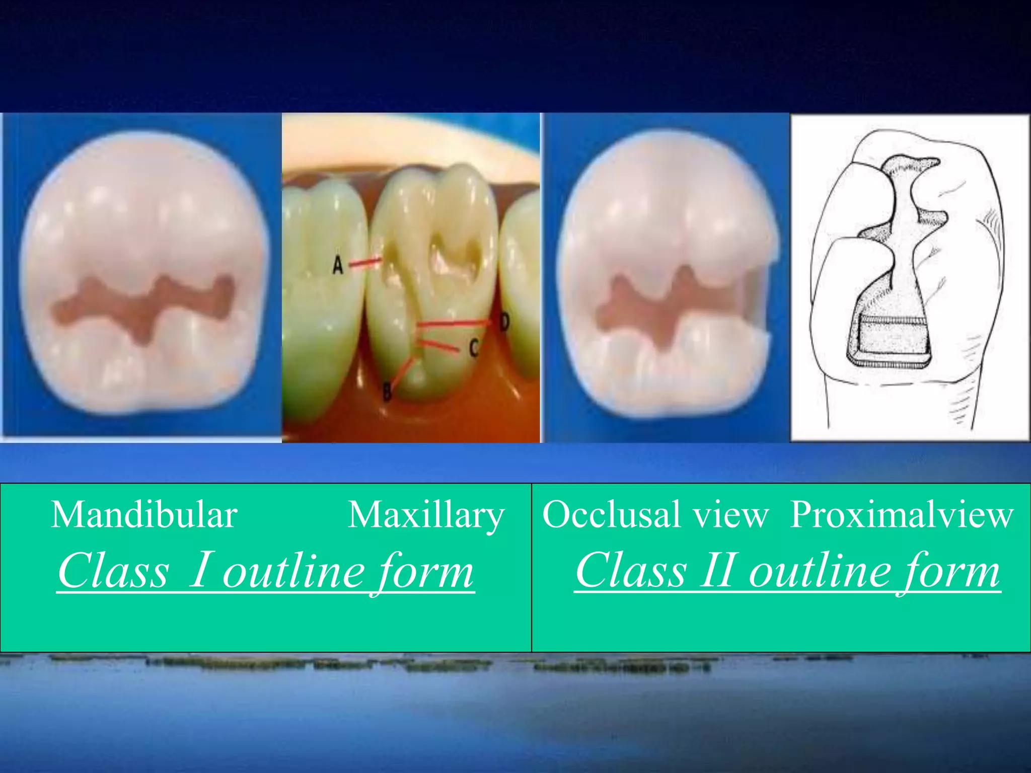 Principles of cavity preparation by Dr .rupali | PPT