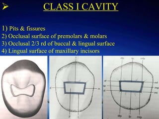 Principles of cavity preparation by Dr .rupali | PPT