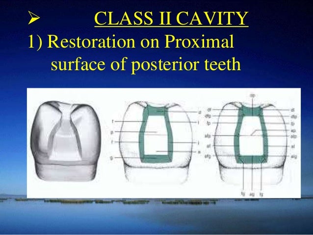 Principles of cavity preparation by Dr .rupali