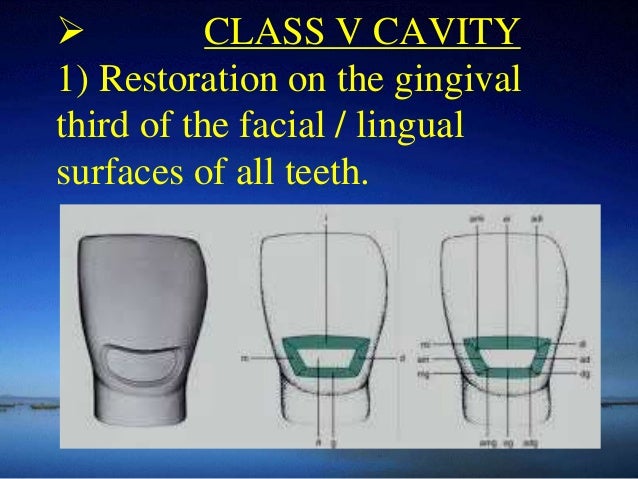 Principles of cavity preparation by Dr .rupali