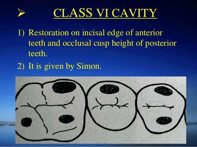 Principles of cavity preparation by Dr .rupali