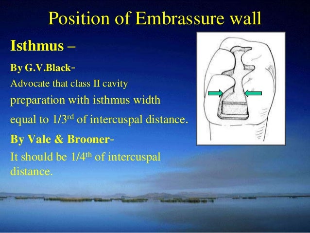 Principles of cavity preparation by Dr .rupali