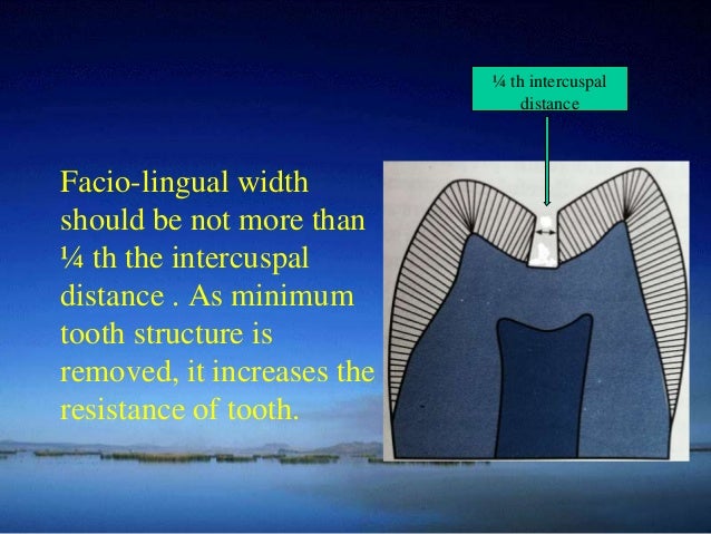 Principles of cavity preparation by Dr .rupali