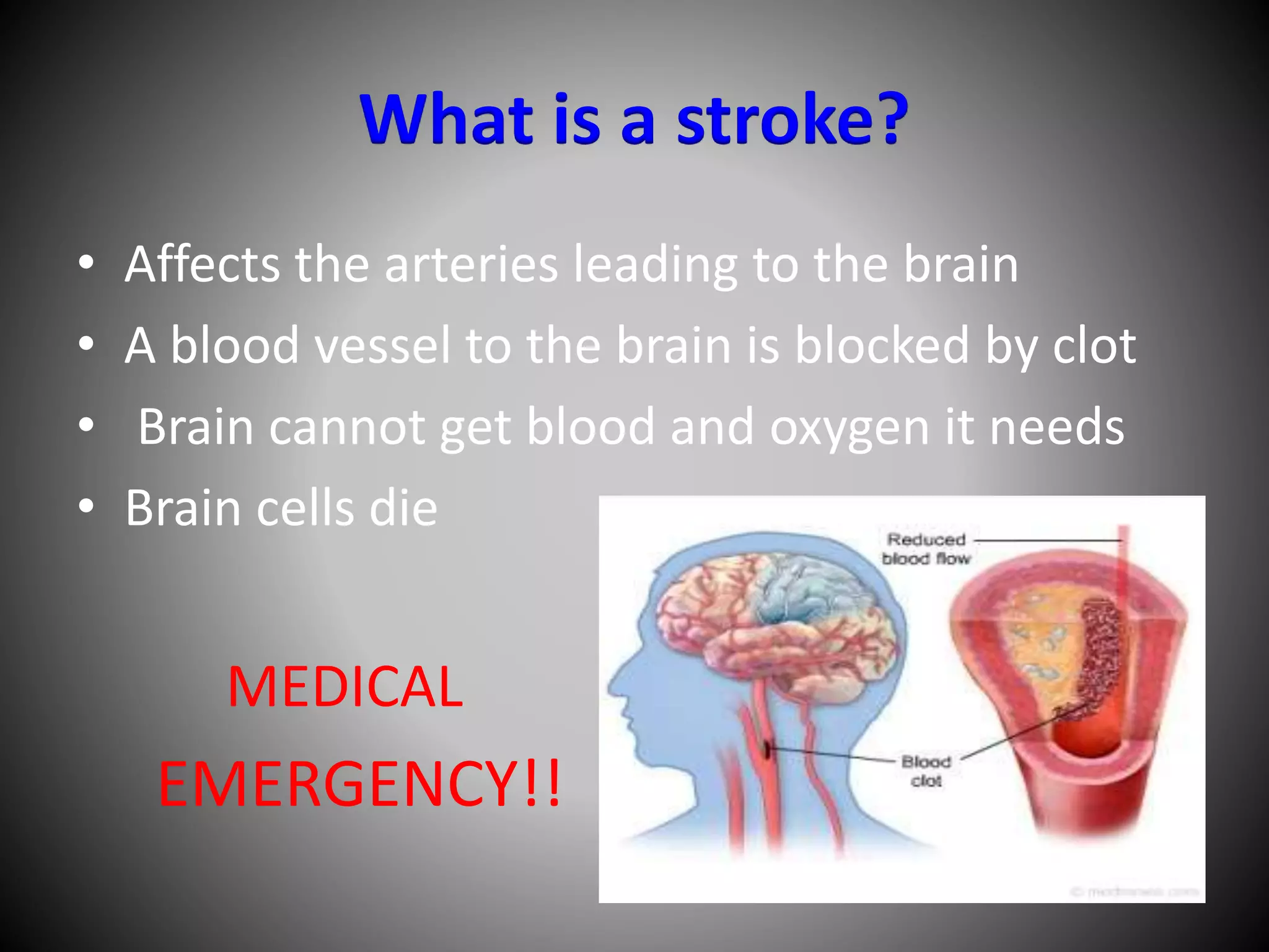 Stroke | PPT