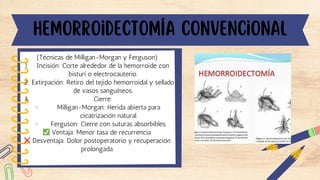 extracción de hemorroides............... | PDF