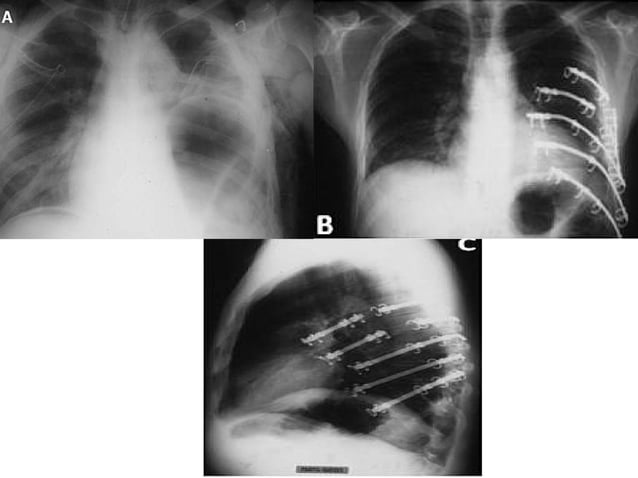 STOVE IN CHEST, FLAIL CHEST AND TRAUMATIC RUPTURE OF DIAPHRAGM.ppt