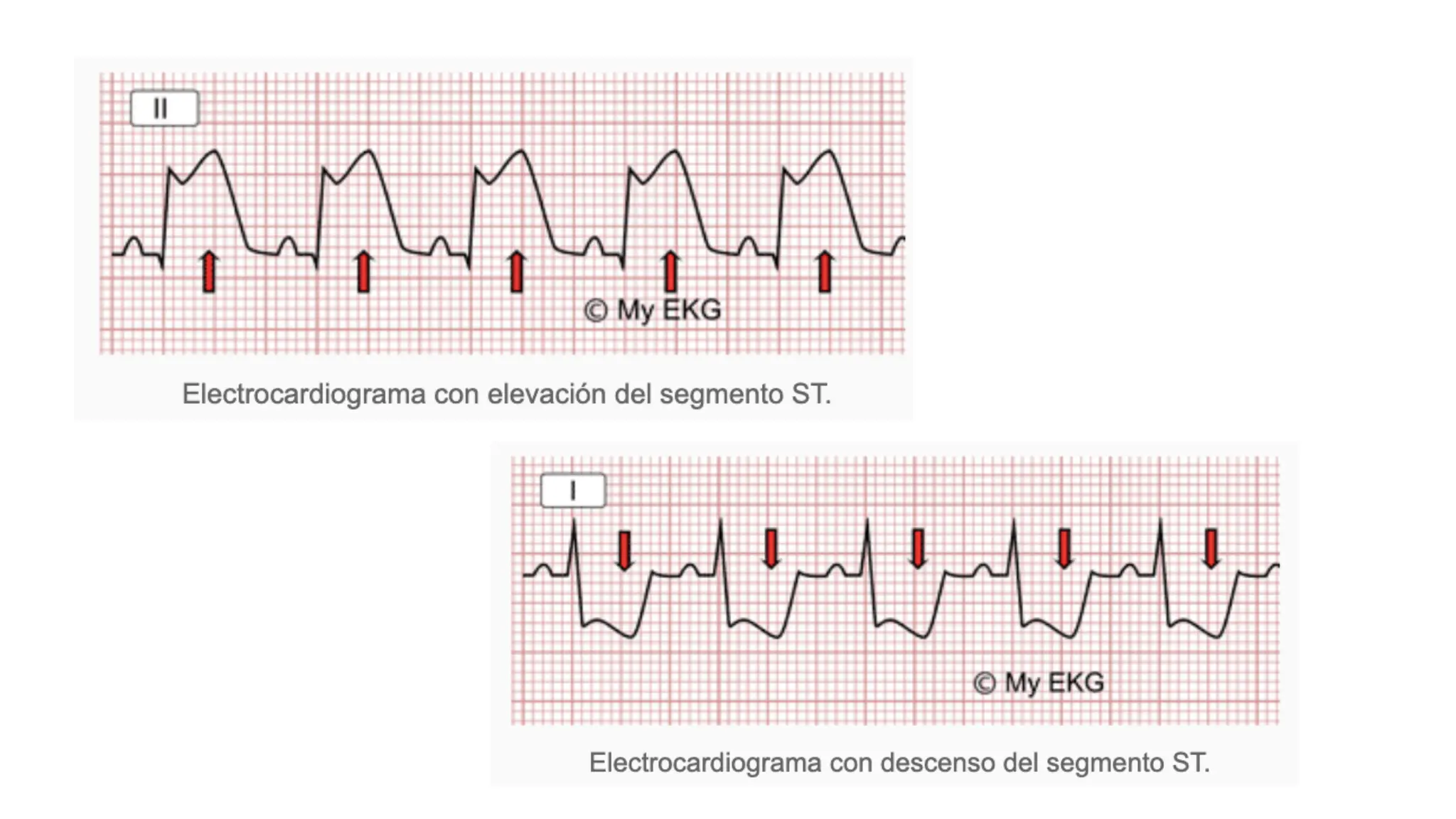 Alteraciones del segmento ST electrocardiograficamante | PDF | Heart ...