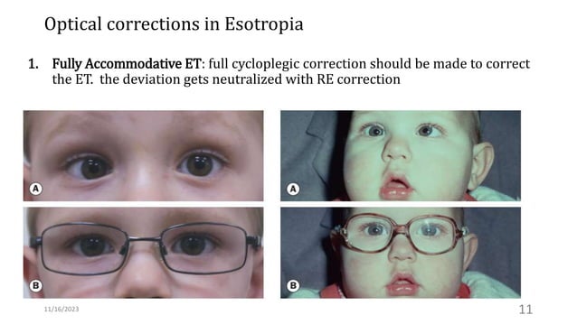 Optical management of strabismus.pptx | Eye and Vision Conditions ...