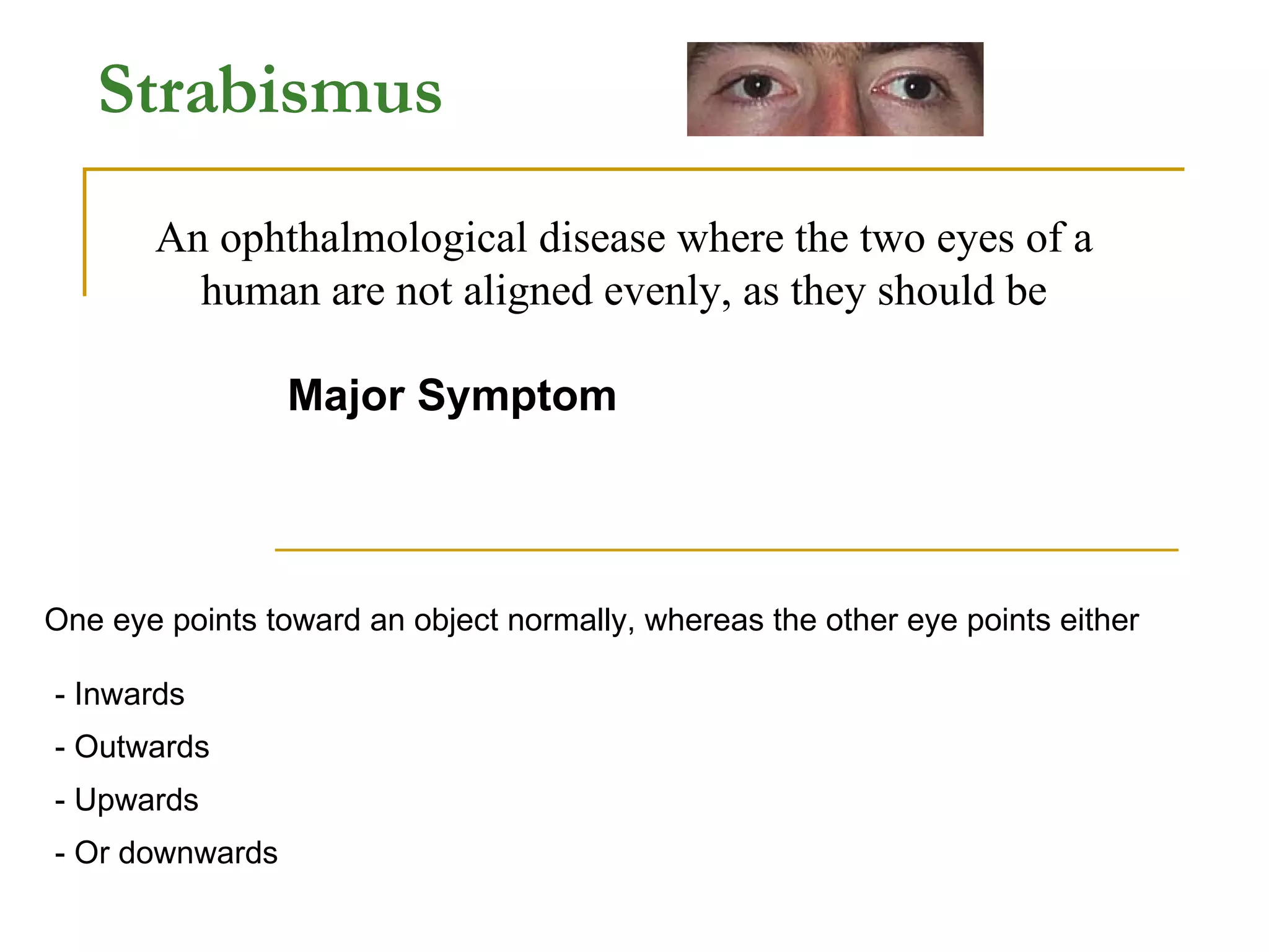 Strabismus | PPT | Eye and Vision Conditions | Diseases and Conditions