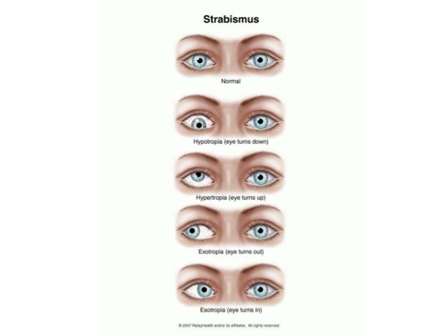 Strabismus