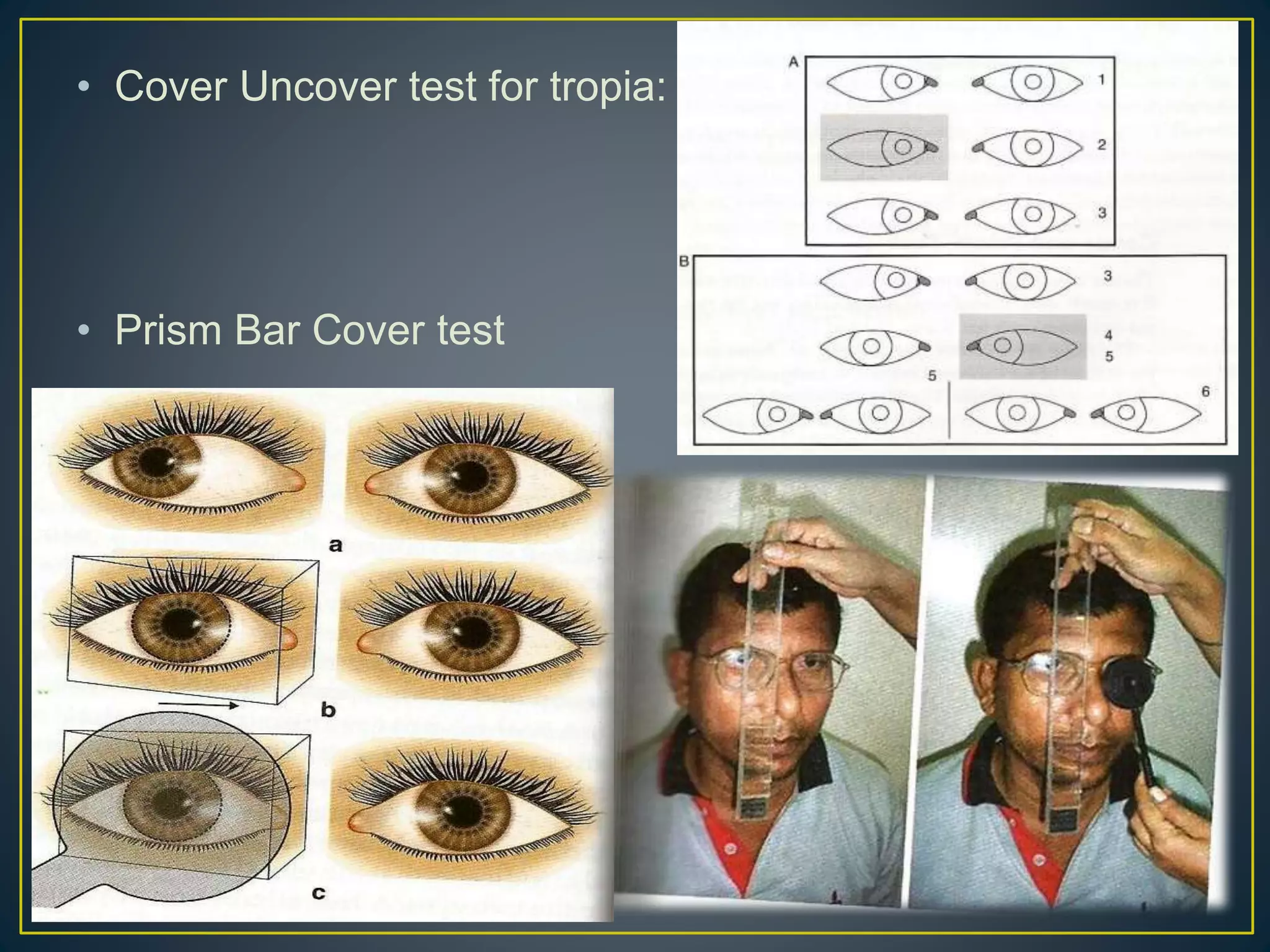 Strabismus-Clinical Examinations | PPTX