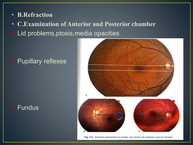 Strabismus-Clinical Examinations | PPTX