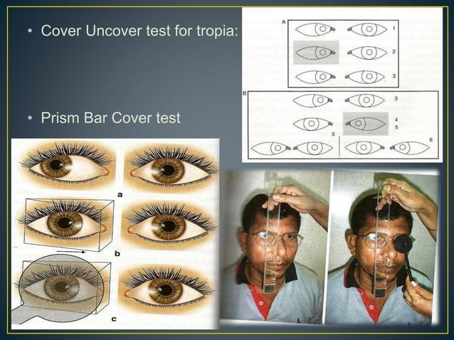 Strabismus-Clinical Examinations | PPTX