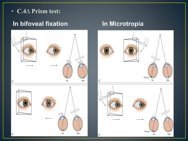 Strabismus-Clinical Examinations | PPTX