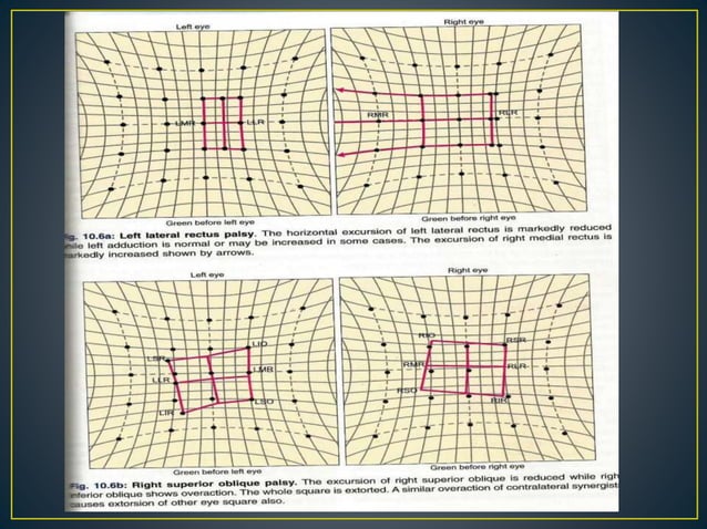 Strabismus-Clinical Examinations | PPTX