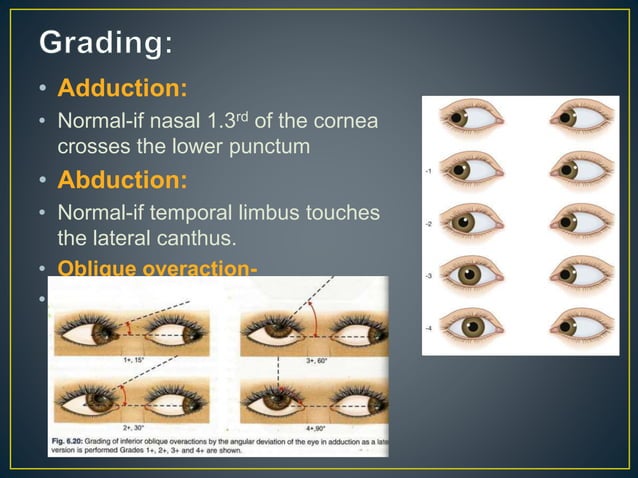 Strabismus-Clinical Examinations