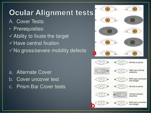 Strabismus-Clinical Examinations