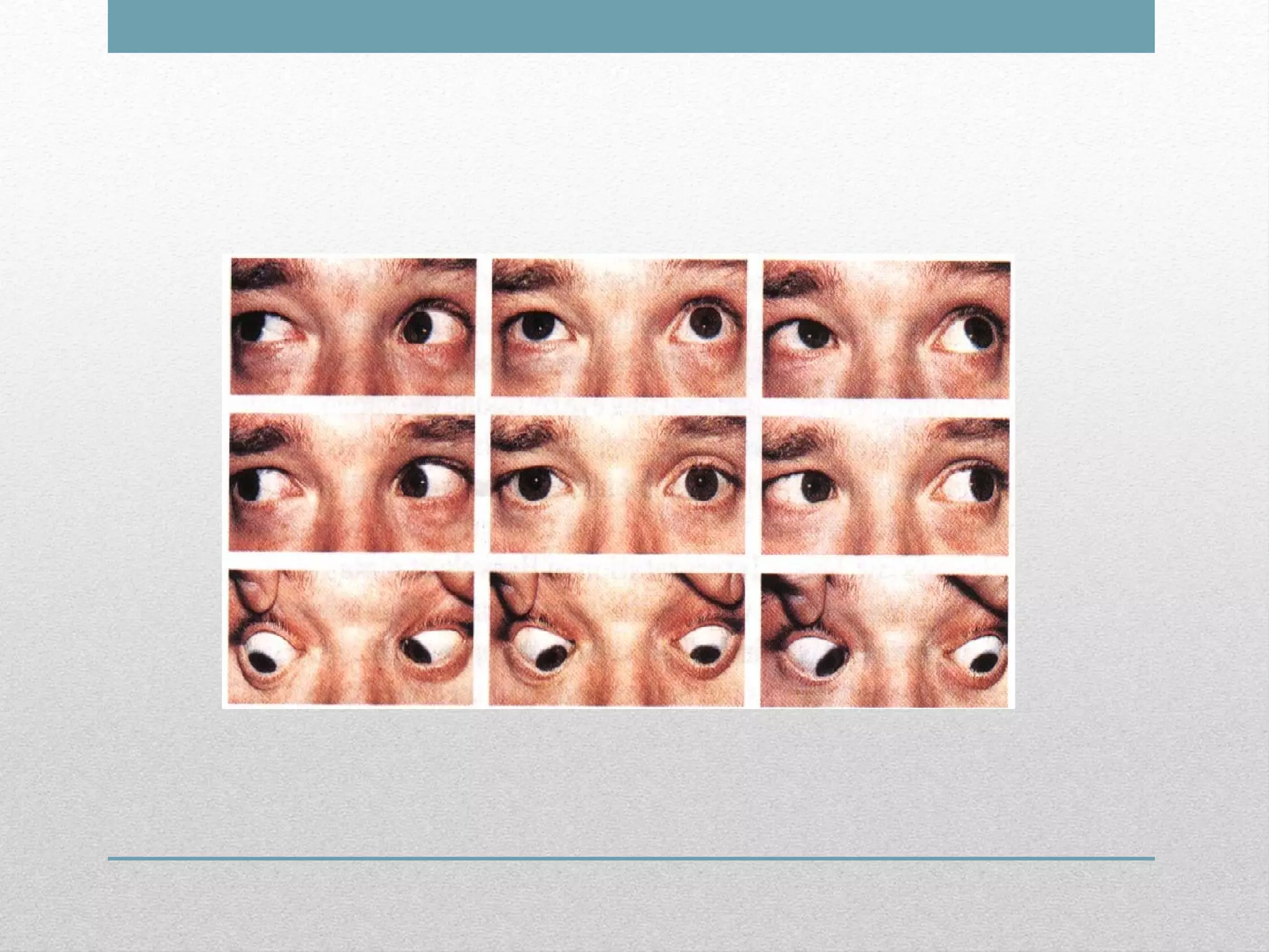 STRABISMUS | PPT