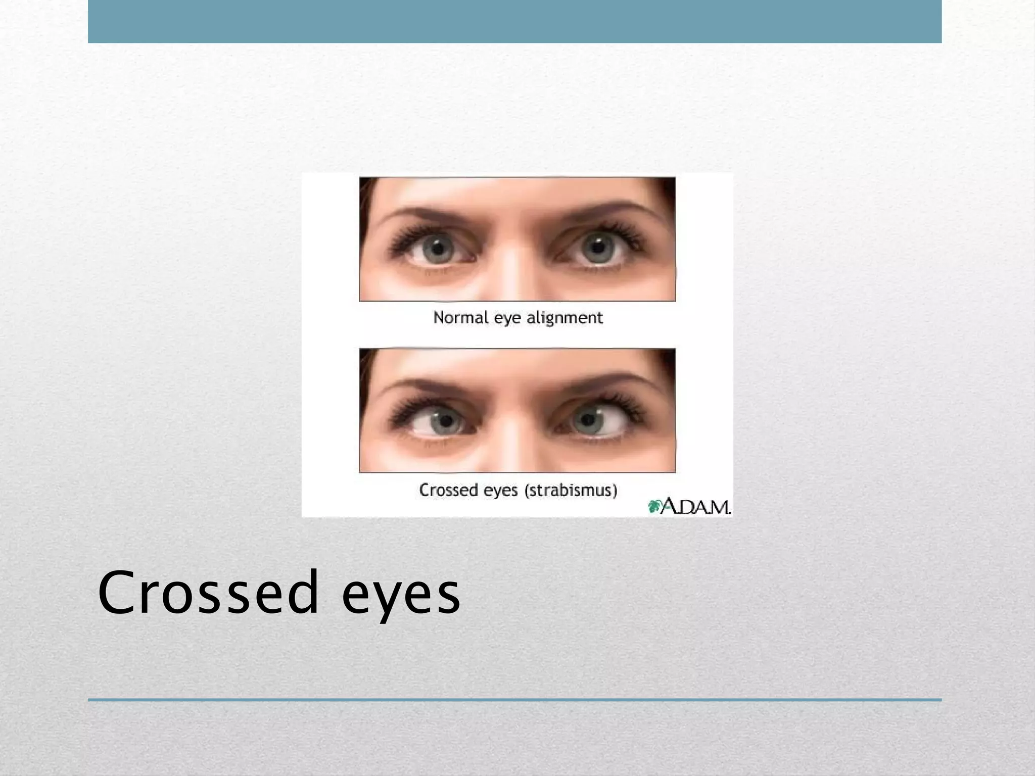 STRABISMUS | PPT