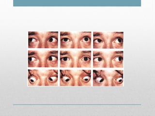 STRABISMUS | PPT