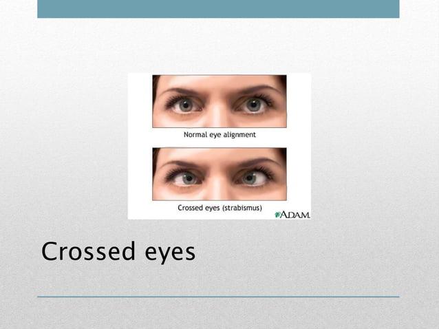 STRABISMUS | PPT