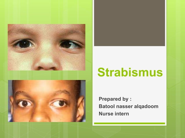 Strabismus | PPTX