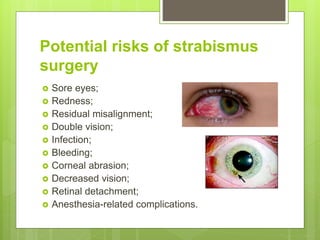 Strabismus | PPTX