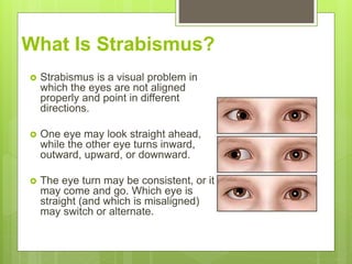 Strabismus | PPTX