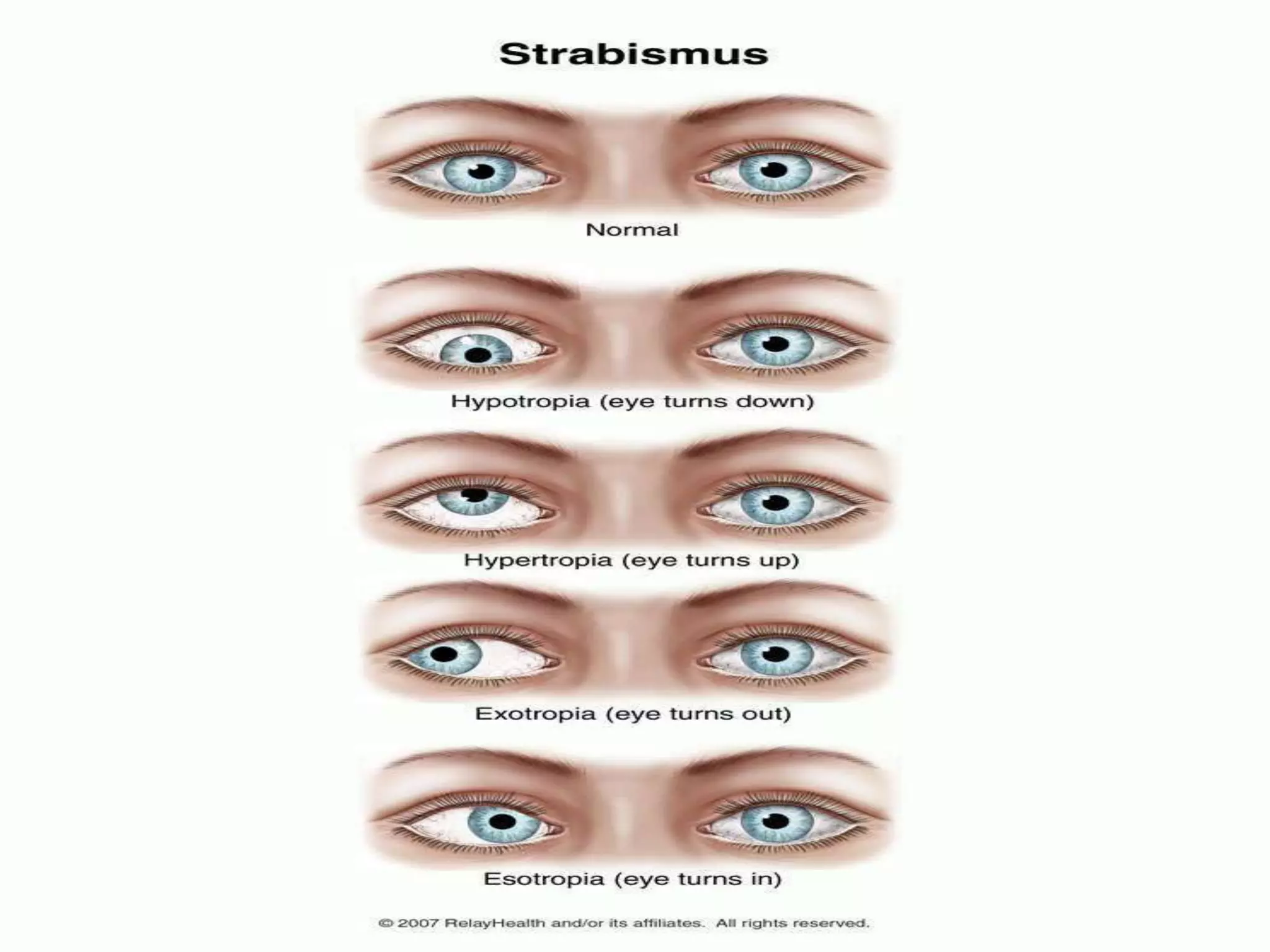 Strabismus | PPTX