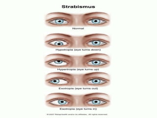 Strabismus | PPTX