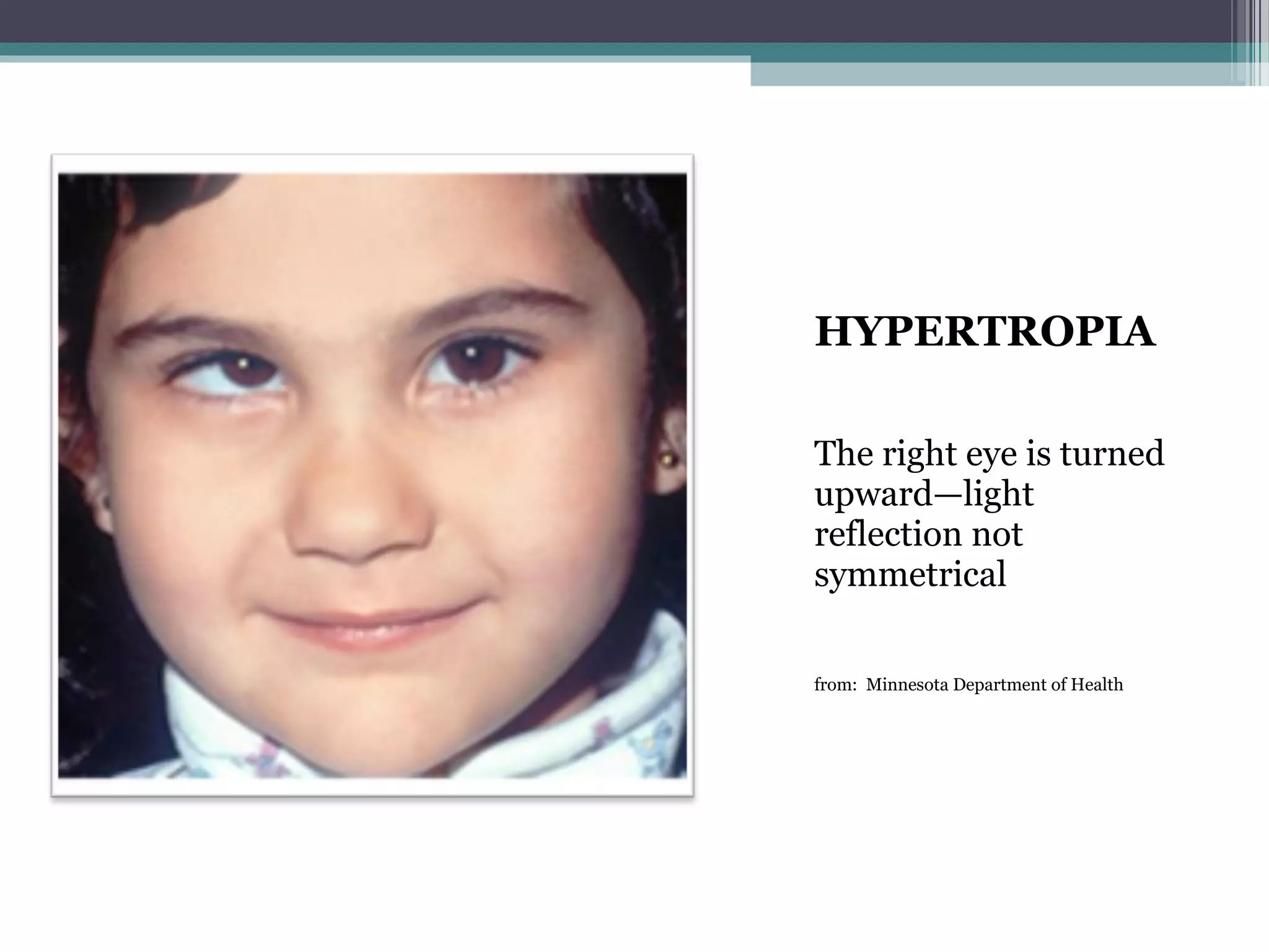 Strabismus | PPT