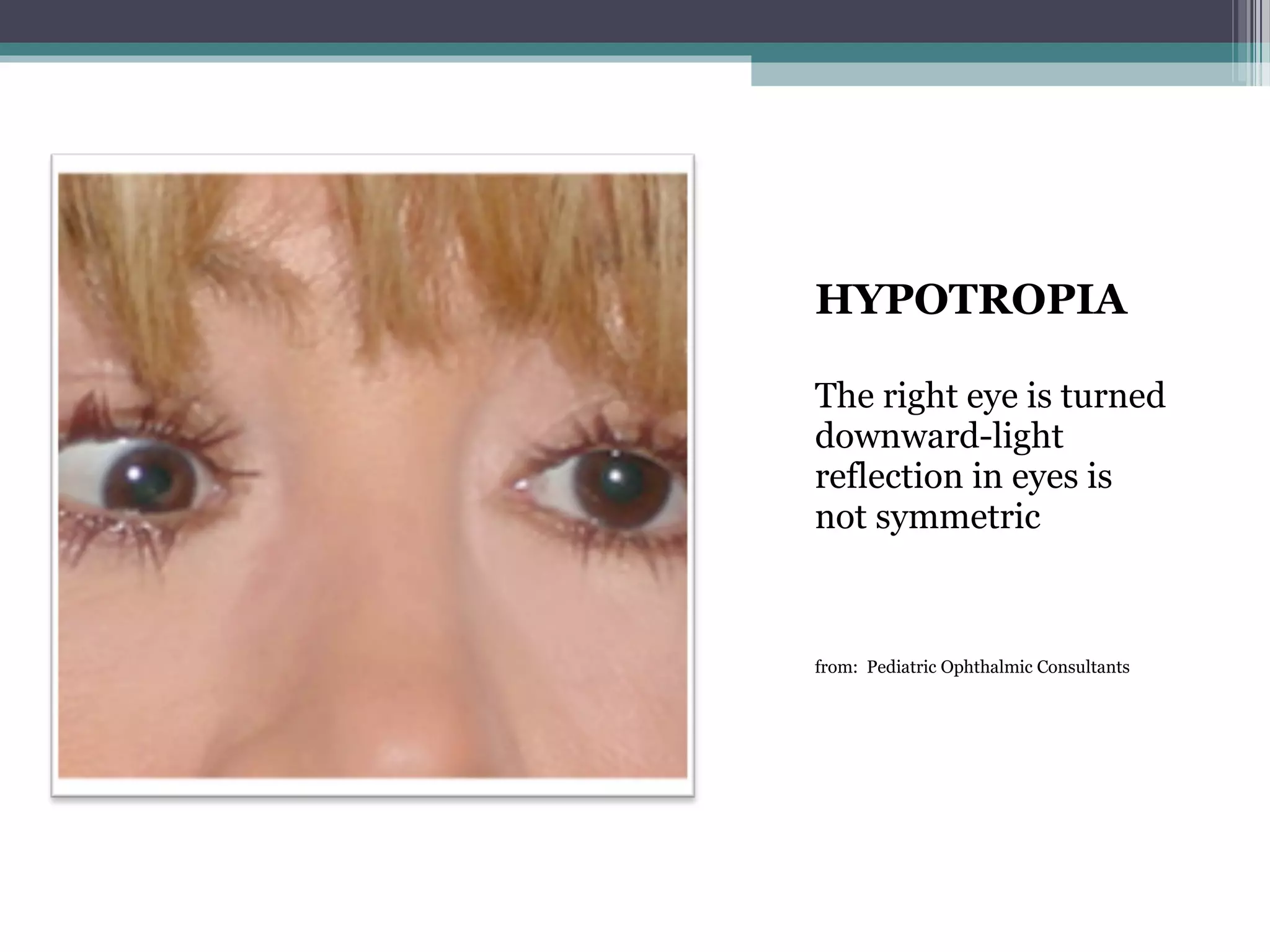 Strabismus | PPT
