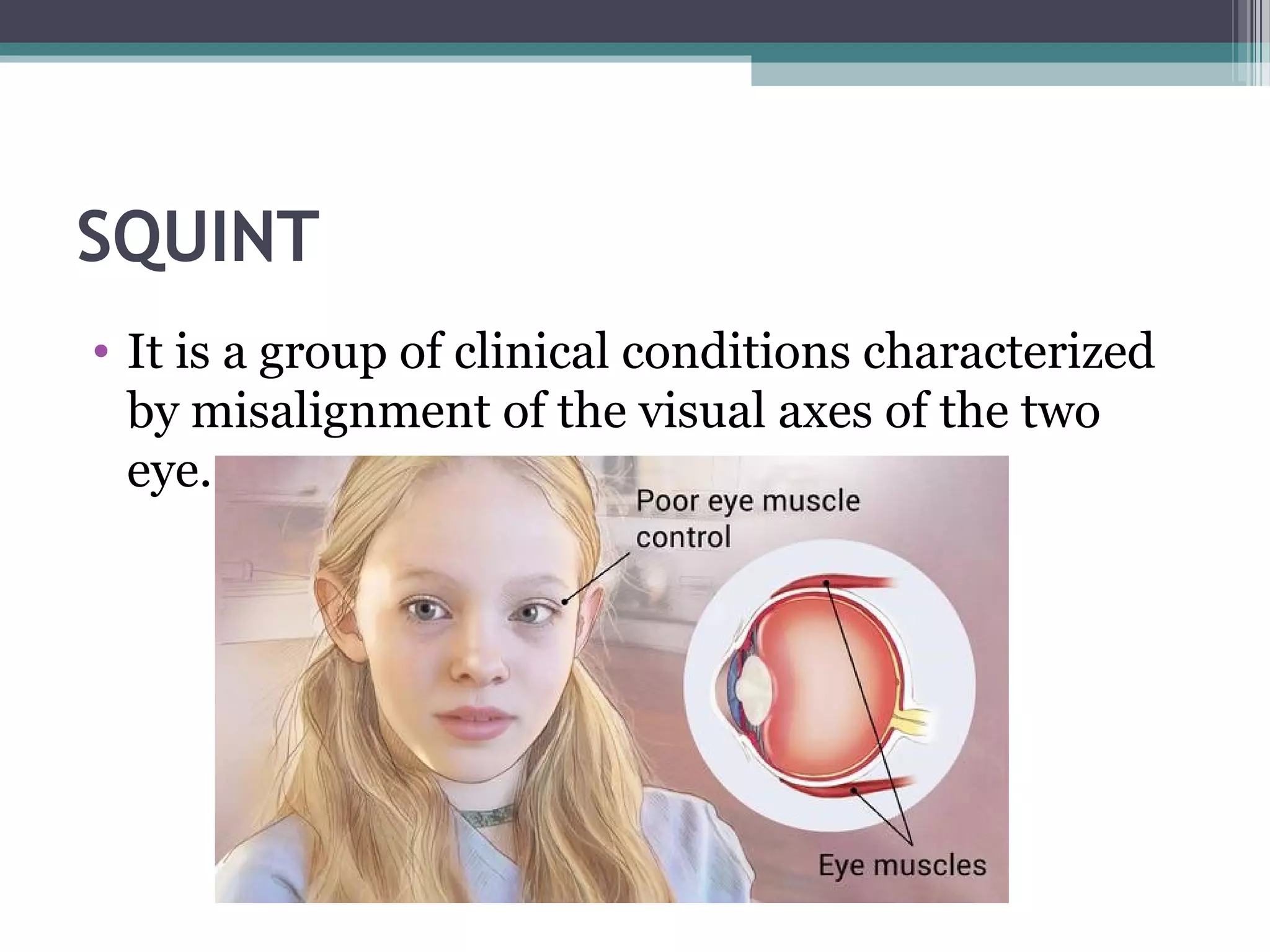 Strabismus | PPT