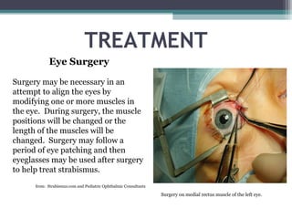 Strabismus | PPT