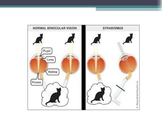 Strabismus | PPT