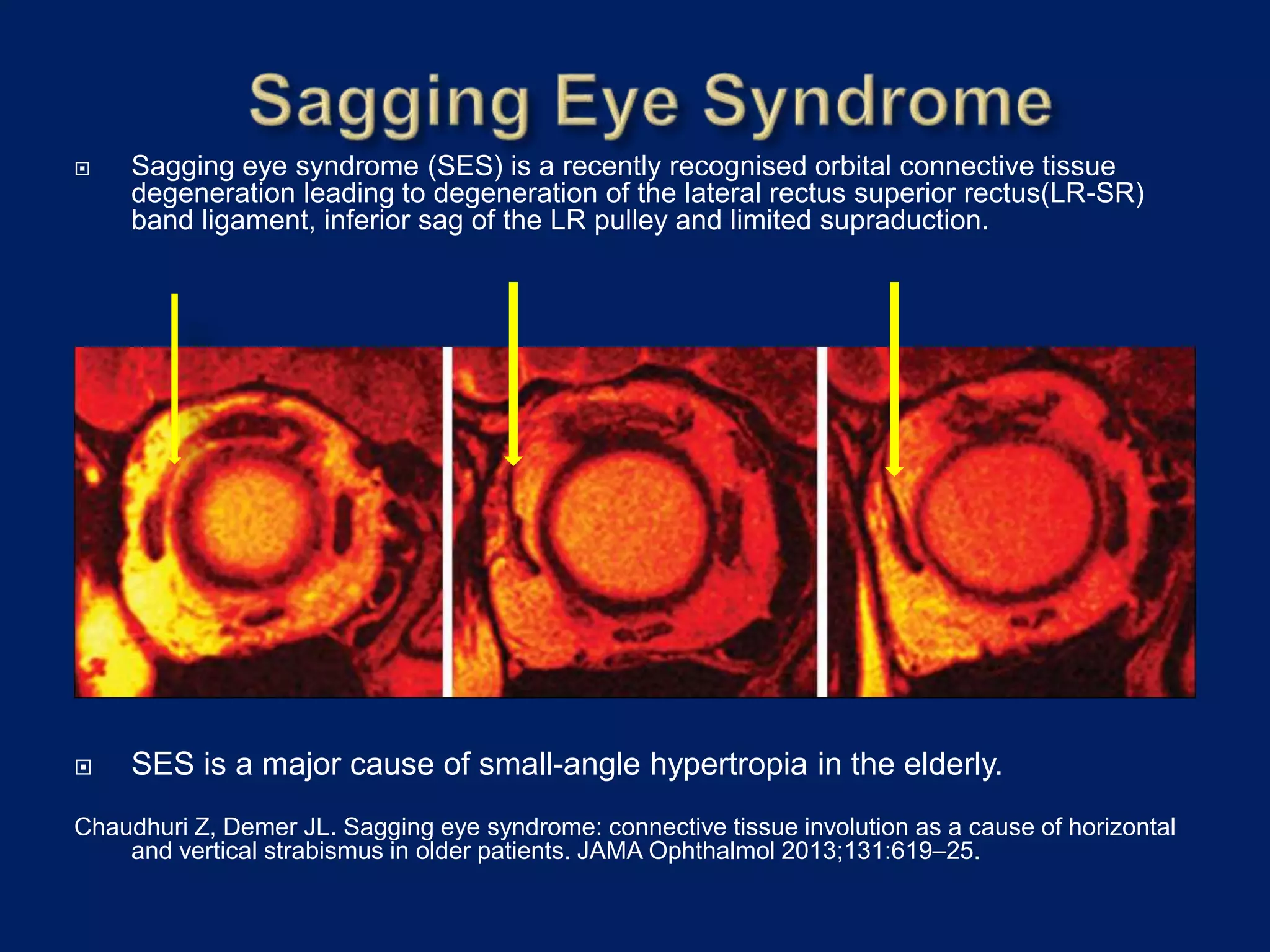 Strabismus | PPTX | Physical Therapy | Wellness