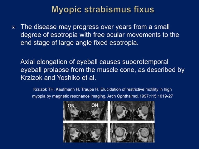 Strabismus | PPTX | Physical Therapy | Wellness