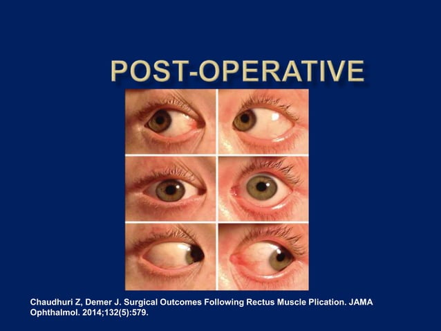 Strabismus | PPTX | Physical Therapy | Wellness