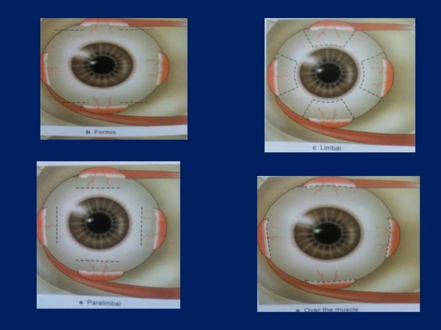 Strabismus | PPTX | Physical Therapy | Wellness