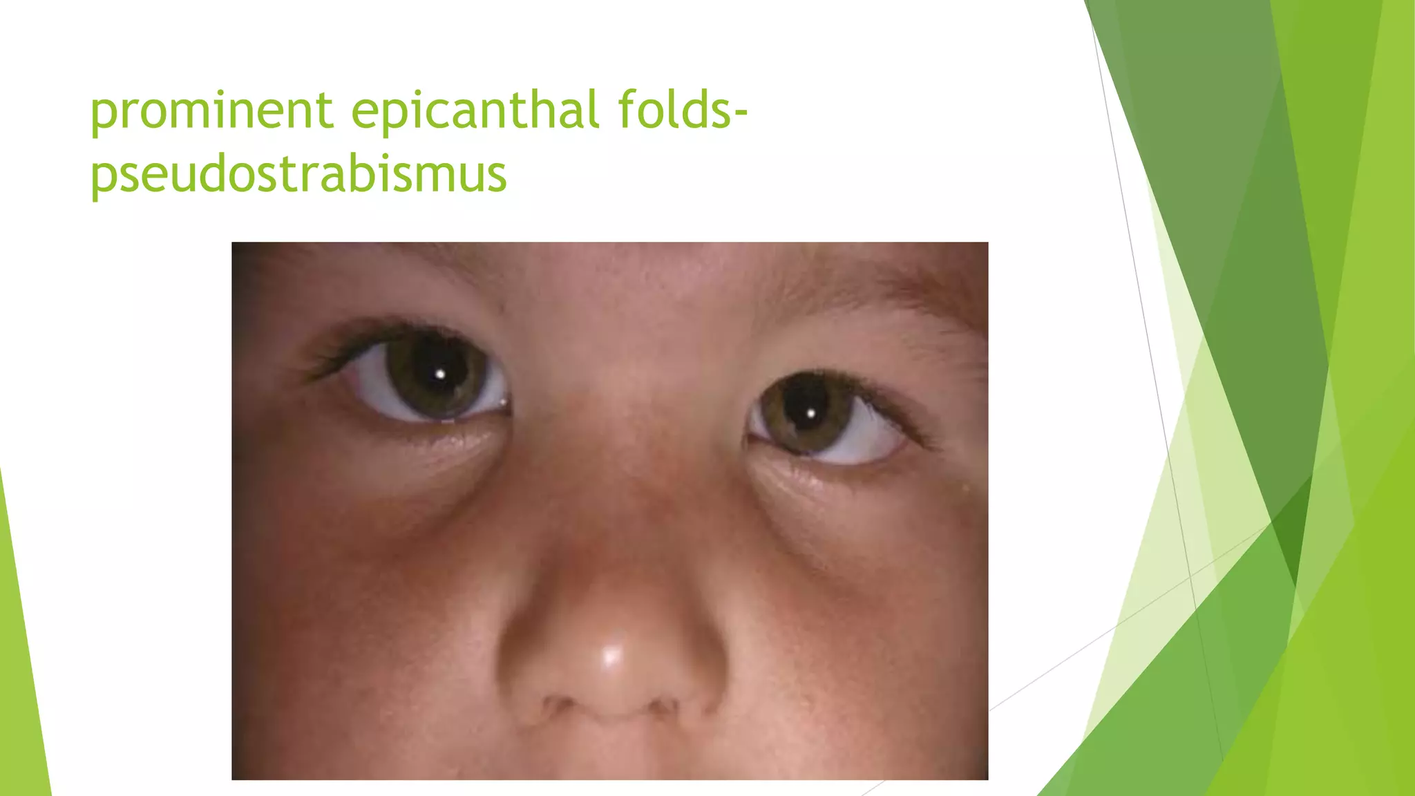 strabismus.pptx