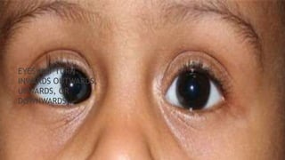 strabismus.pptx