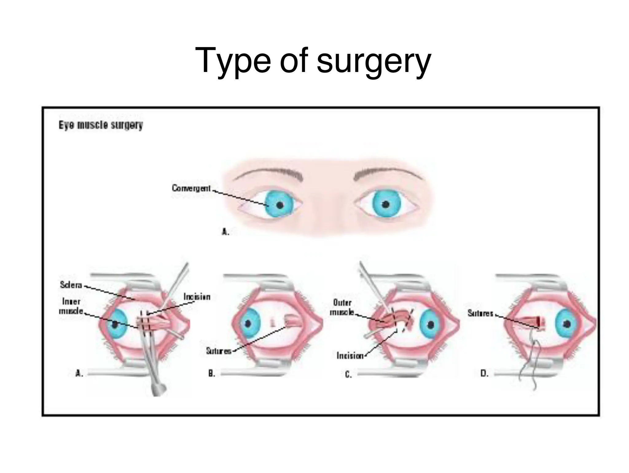 Strabismus .pdf ophthalmology bbbbbbbbbb | PPT
