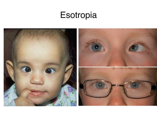 Strabismus .pdf ophthalmology bbbbbbbbbb | PPT