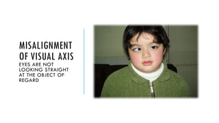 Strabismus and it's evaluation and treatment | PPTX