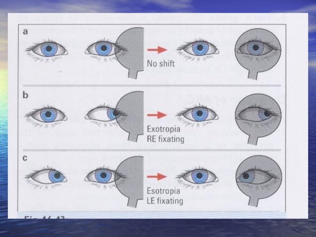 Strabismus | PPT
