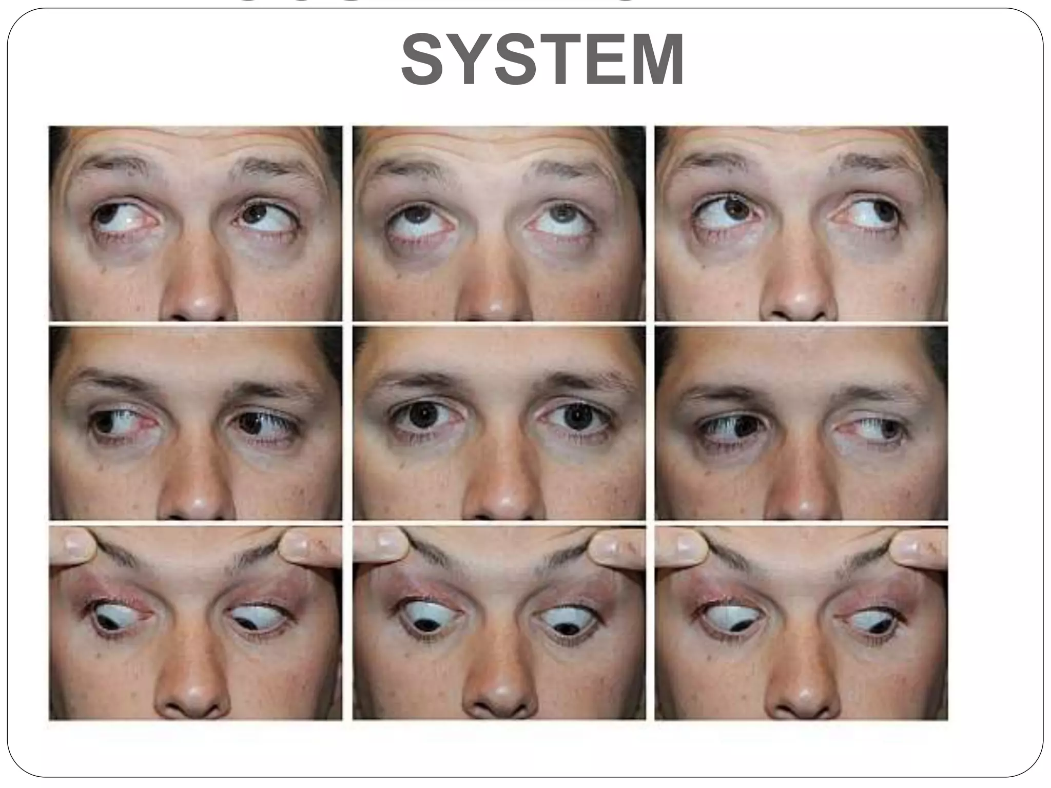 Strabismus - Dr. Halal | PPTX
