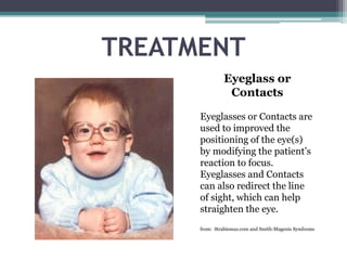 Strabismus basic for ophthalmic assistant student | PPT