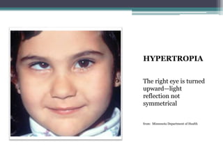 Strabismus basic for ophthalmic assistant student | PPT