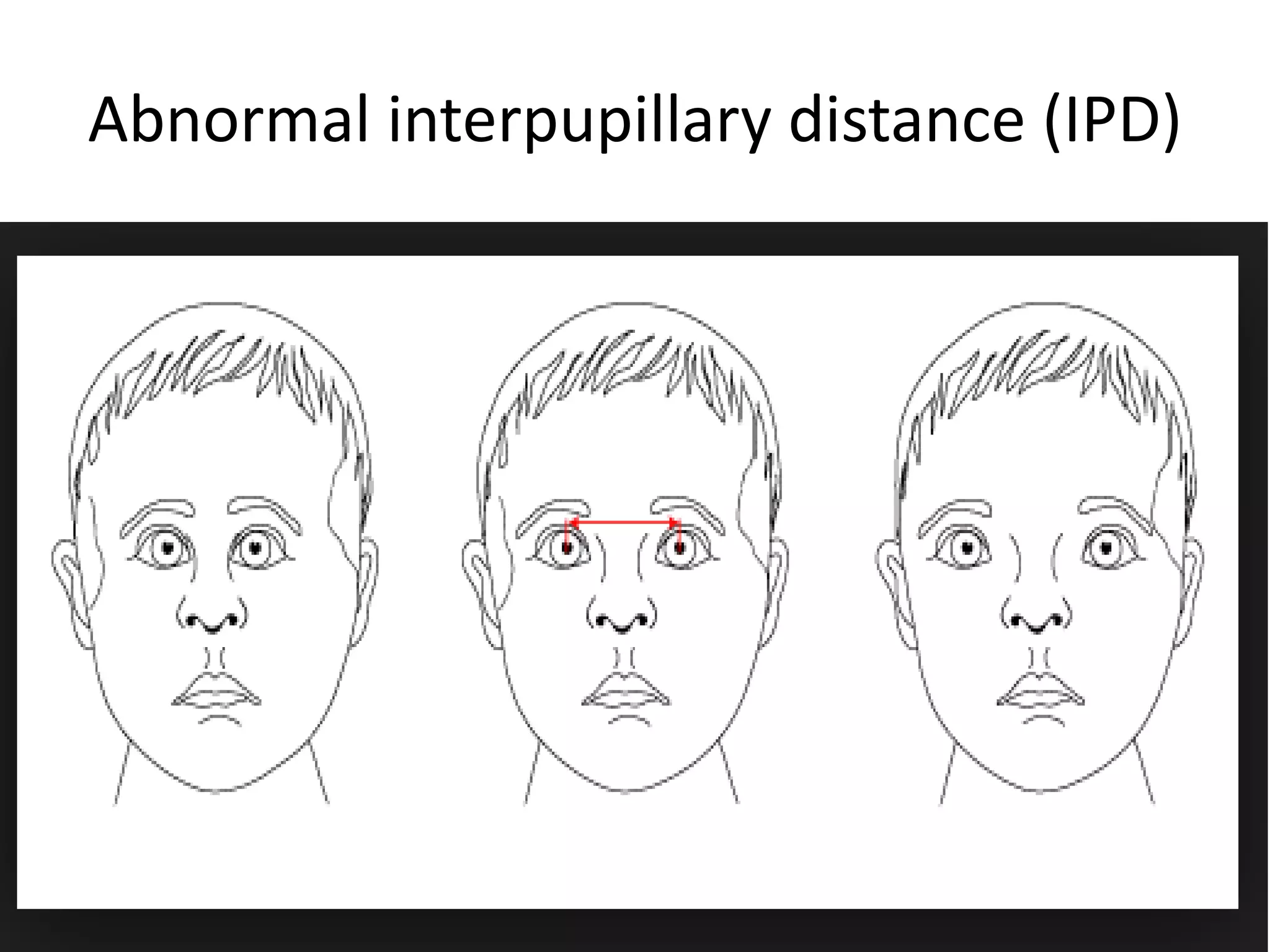 Strabismus and squint | PPTX