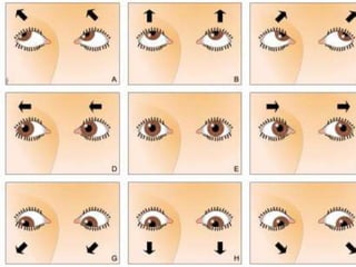 Strabismus and squint | PPT